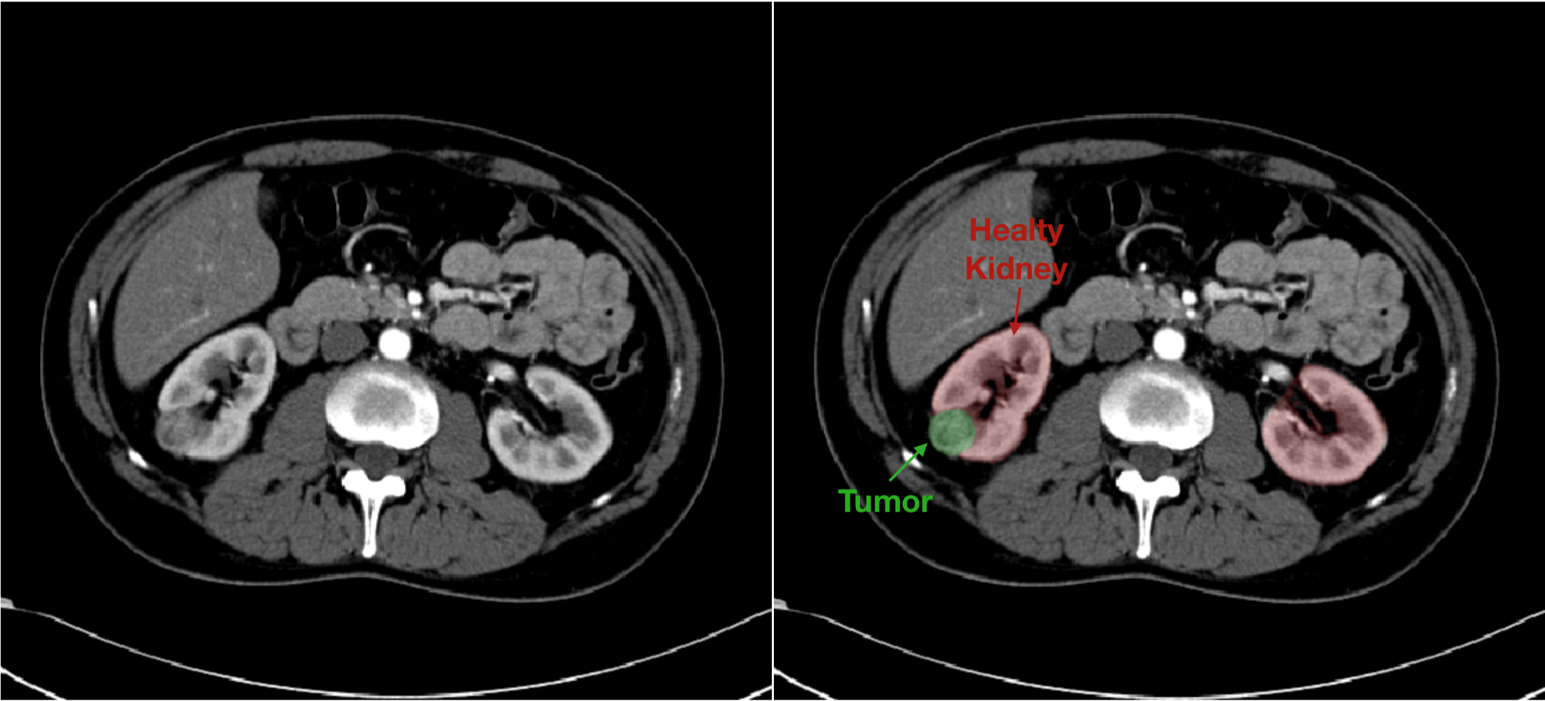 AI in Medical Imaging: The Kidney Tumor Segmentation Challenge AI in Medical Imaging: The Kidney Tumor Segmentation Challenge