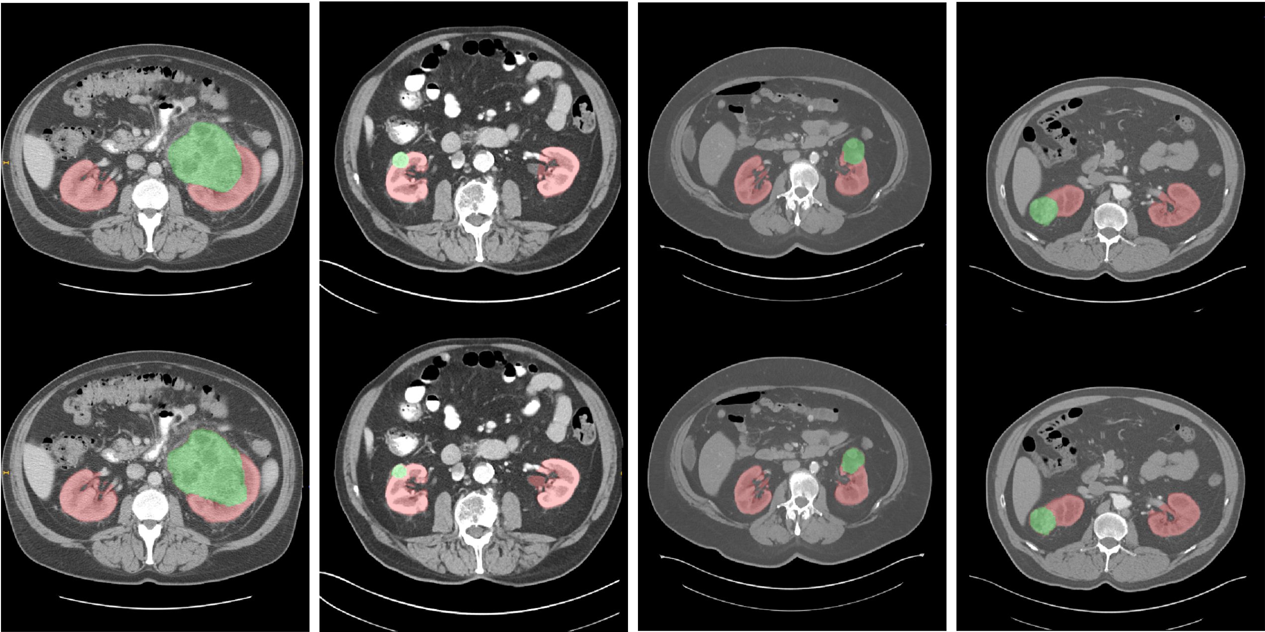 AI in Medical Imaging: The Kidney Tumor Segmentation Challenge AI in Medical Imaging: The Kidney Tumor Segmentation Challenge